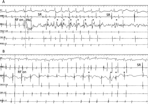 Development Of Accelerated Ectopic Atrial Cycles During Radiofrequency