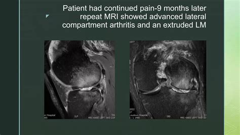 Lateral Meniscus Root Tears Neglected Cases Ppt