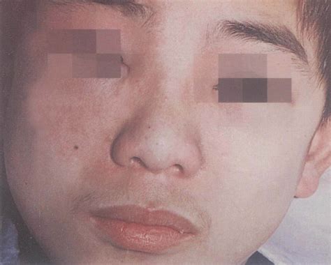 皮肌炎 临床实用皮肤病性病图谱