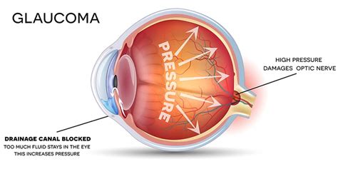 Glaucoma Delaware Ophthalmology Consultants