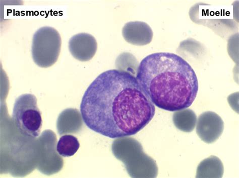 Plasmocytes Vs Lymphocytes Hematology Medical Laboratory Science Medical Laboratory