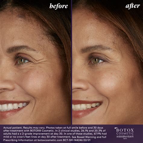 Best Botox Injection Migraines In Florida Wildwood Sunshine