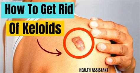 How To Get Rid Of Keloids Keloid Scar Removal Natural Ways To Remove Keloids