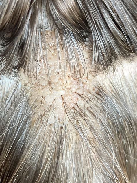 Growth On Scalp Can Anyone Tell Me What It Is R Warts