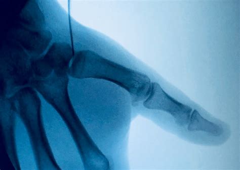 Medical Imaging Procedures Arthrogram Sonos Imaging