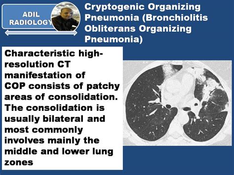 Cryptogenic Organizing Pneumonia Radiology Classroom