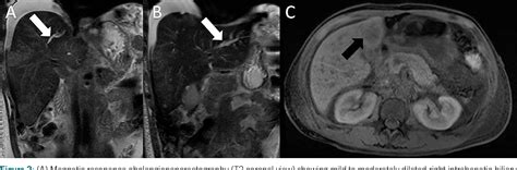 Pdf Disseminated Aids Related Kaposi Sarcoma Immune Reconstitution