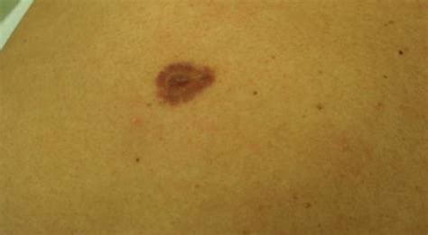 Hobnail Hemangioma Wikiprojectmed