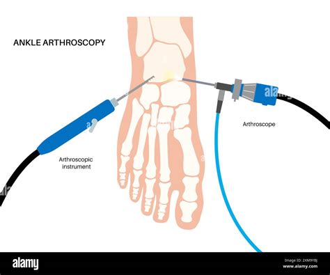 Illustration Of An Ankle Arthroscopy Procedure This Is A Procedure For