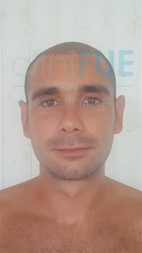 Trasplante capilar de Jose 30 Años de Murcia con cliniFUE cliniFUE