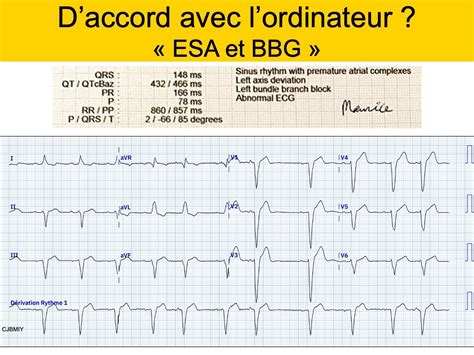 Physiologie Page 8 Sur 18 E Cardiogram