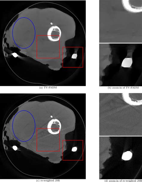 Figure 13 From A Reweighted Joint Spatial Radon Domain Ct Image Reconstruction Model For Metal