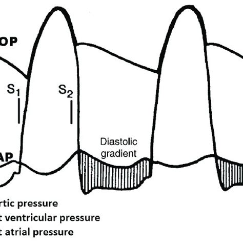 Physiopathology Of Mitral Stenosis Demonstrating The Diastolic