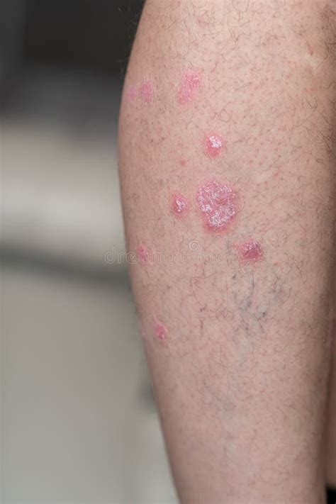 Psoriasis Vulgaris Skin Patches Are Typically Red Itchy And Scaly
