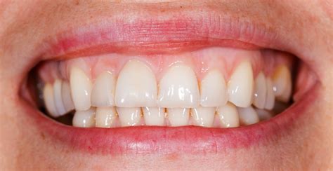 4 Tips To Avoid Occlusion Confusion Spear Education