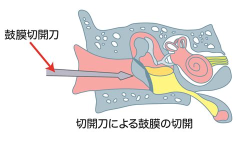 急性中耳炎と滲出性中耳炎の原因・症状・治療法｜日帰り手術に対応｜大阪府門真市の門真市の耳鼻科ならばば耳鼻科・日帰り手術クリニック