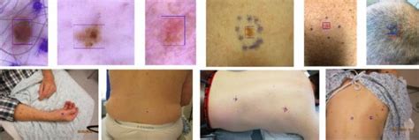 Dermoscopy Excellence On Linkedin 🧑‍⚕️ Lesion Identification And