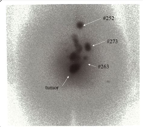Preoperative Lymphoscintigraphy After Endoscopic Injection Of Radio