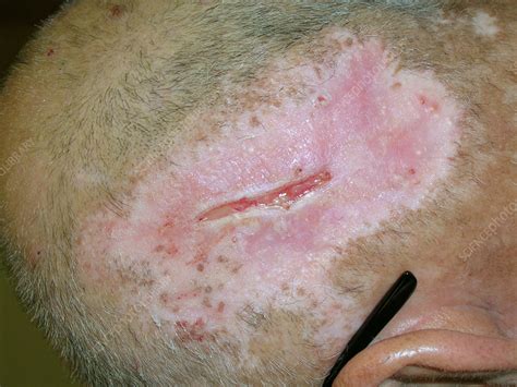 Scalp Ulcer Due To Itching Stock Image C056 5106 Science Photo Library