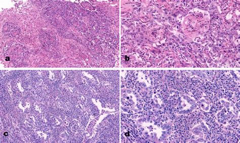 A Solid Sheets Of Squamous Cells Admixed With Inflammatory Cells