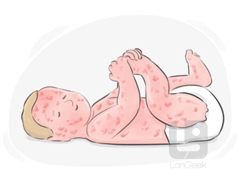 Definition And Meaning Of Measles Langeek