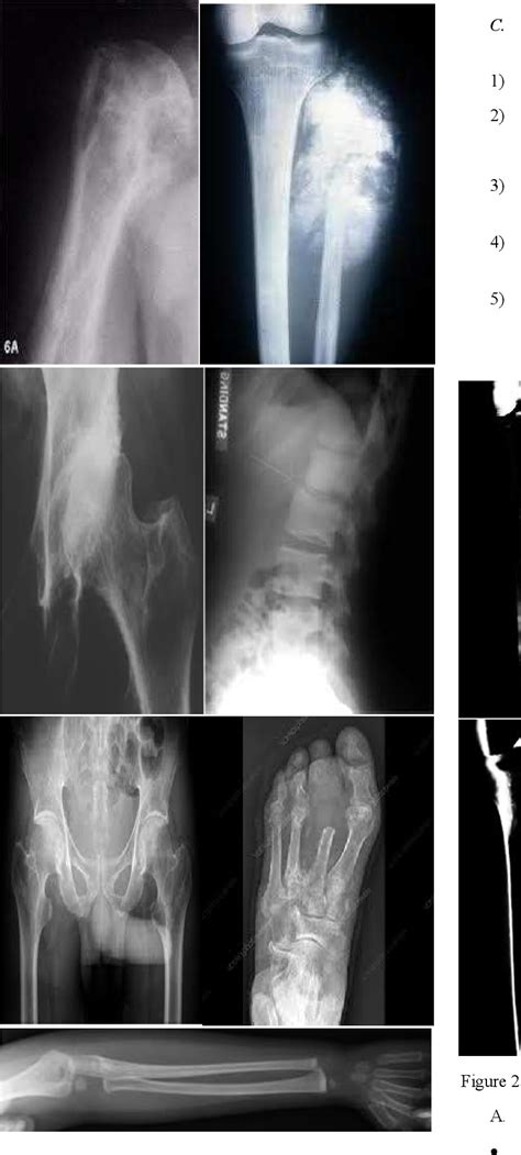 Figure 2 From Bone Age Classification Using Cnn Algorithm Semantic
