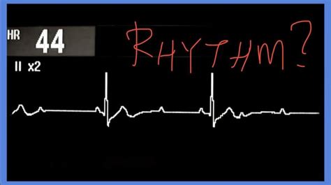 Acls Ecg Rhythm Test Your Acls Skills Rfoamed911