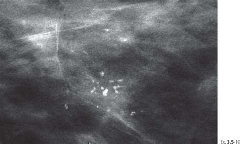 Multiple Clusters Of Crushed Stone Like Calcifications On The Mammogram Produced By Malignant