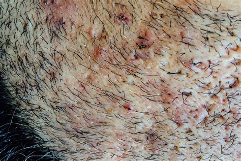 Male Genital Ingrown Hair