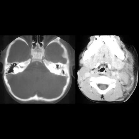 Pediatric Acute Mastoiditis Pediatric Radiology Reference Article