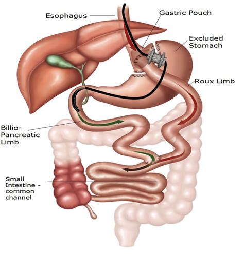 Internal Edge Eus Directed Transgastric Ercp Procedure Dallas And Plano