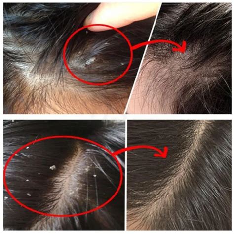 Scalp Discoloration From Selenium Sulfide Shampoo A Case