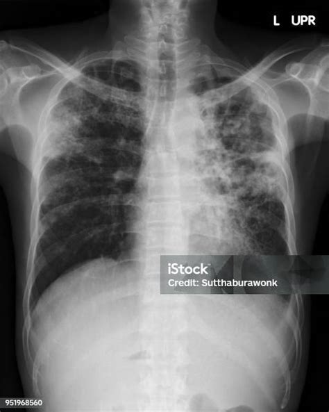Rontgen Dada Posisi Tegak Ap Foto Stok Unduh Gambar Sekarang Fibrosis Paru Paru Bahu Istock
