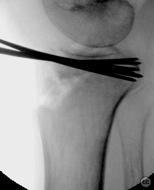 Proximal Tibia Hyperextension Fracture In An Osteopenic Patient