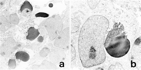 Electron Micrograph Of Pyknotic Cells In The Fetal Cns Condensation Of Download Scientific