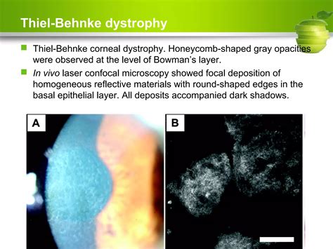 Confocal Microscopy Of The Eye Ppt Eye And Vision Conditions