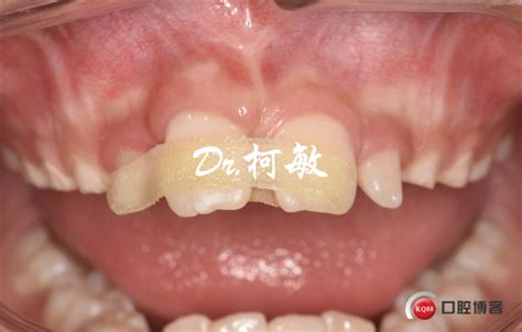 年轻恒牙外伤脱落后牙再植 柯敏的博客 Kq88口腔博客