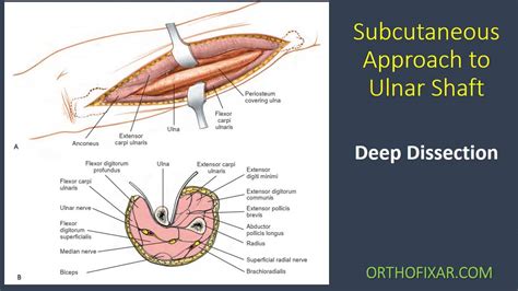 Subcutaneous Approach To Ulnar Shaft Orthofixar 2025