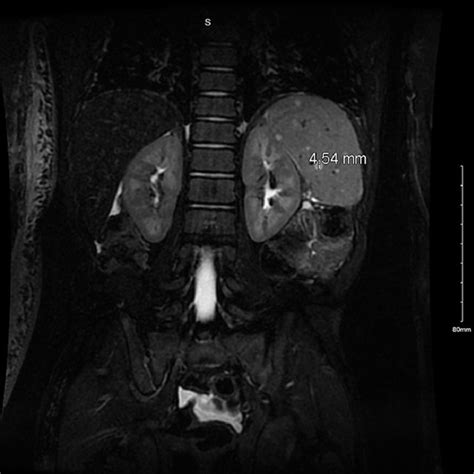 Mri Identifying Splenic Lesions Arrows Removed For Better