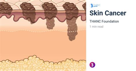 Skin Cancer Diagram