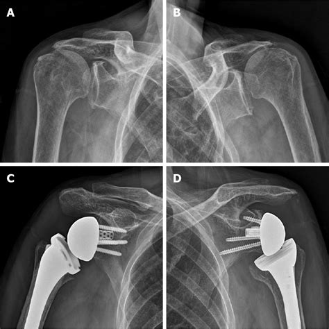 Simultaneous Bilateral Acromial Base Fractures After Staged Reverse Total Shoulder Arthroplasty