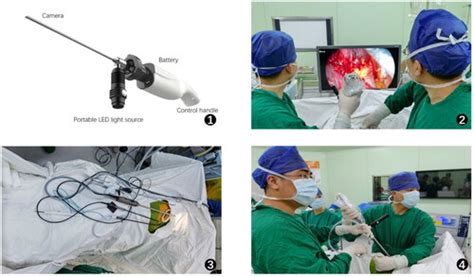 Full Article Application Of Wireless Thoracoscopy In Thoracic Surgery