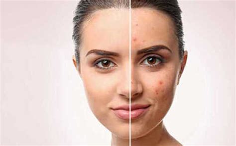 Best Acne Scars Treatments In Hyderabad Acne Scar Treatment Needshub