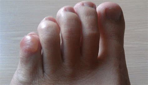 새끼발가락 부음 발가락 부종 원인 및 증상 관절염 통풍 등에 대한 정보
