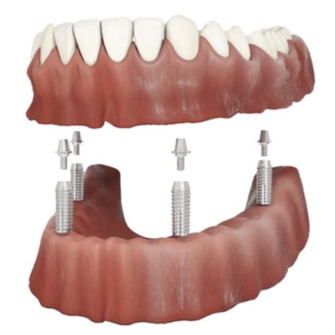 Implant Retained Dentures Smile Style Dental Bulleen