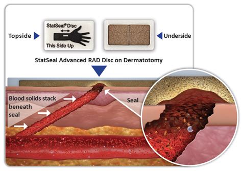 Interventional Cardiology Statseal