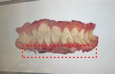 치아교정칫솔 위턱 아래턱 교정 진행과정 후기 네이버 블로그