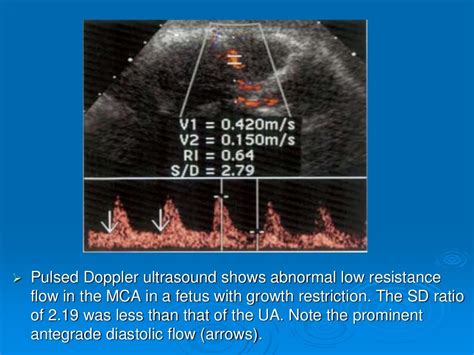 Antenatal Doppler