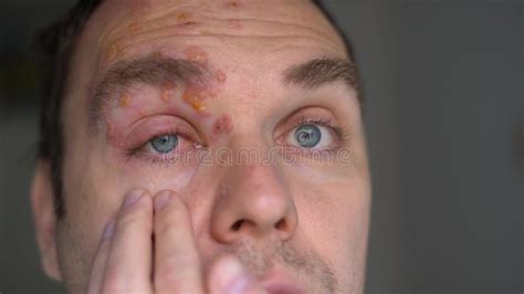 Man With Herpes Zoster Shingles On Face Close Up Inflamed Eyelid