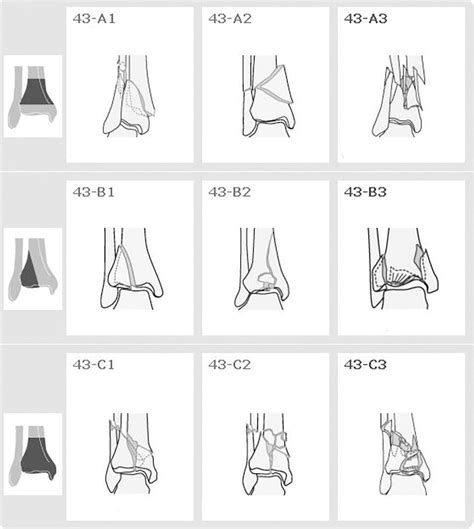 Management Of Pilon Fractures Clinics In Podiatric Medicine And Surgery Management Of Pilon Fractures Clinics In Podiatric Medicine And Surgery